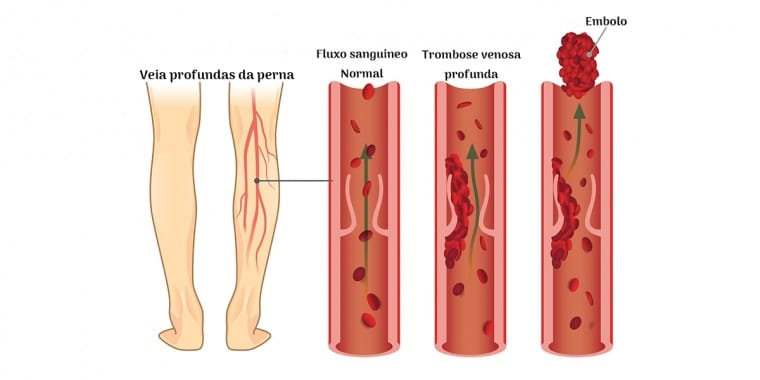 Trombose: dores nas pernas, inchaço, feridas, fique atento aos sintomas