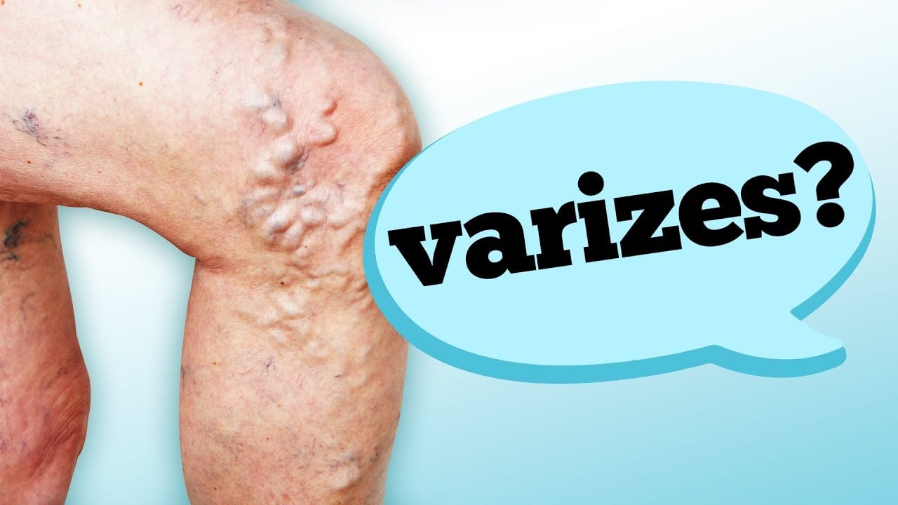 Varizes: 8 remédios alternativos para tratá-las e viver melhor